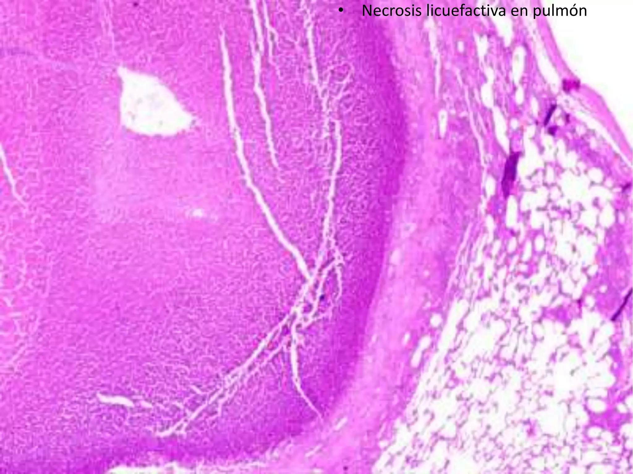 Necrosis y calcificación patológica | PPT