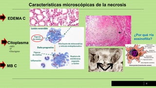NECROSIS licuefactiva gangrenosa caseosa .pptx