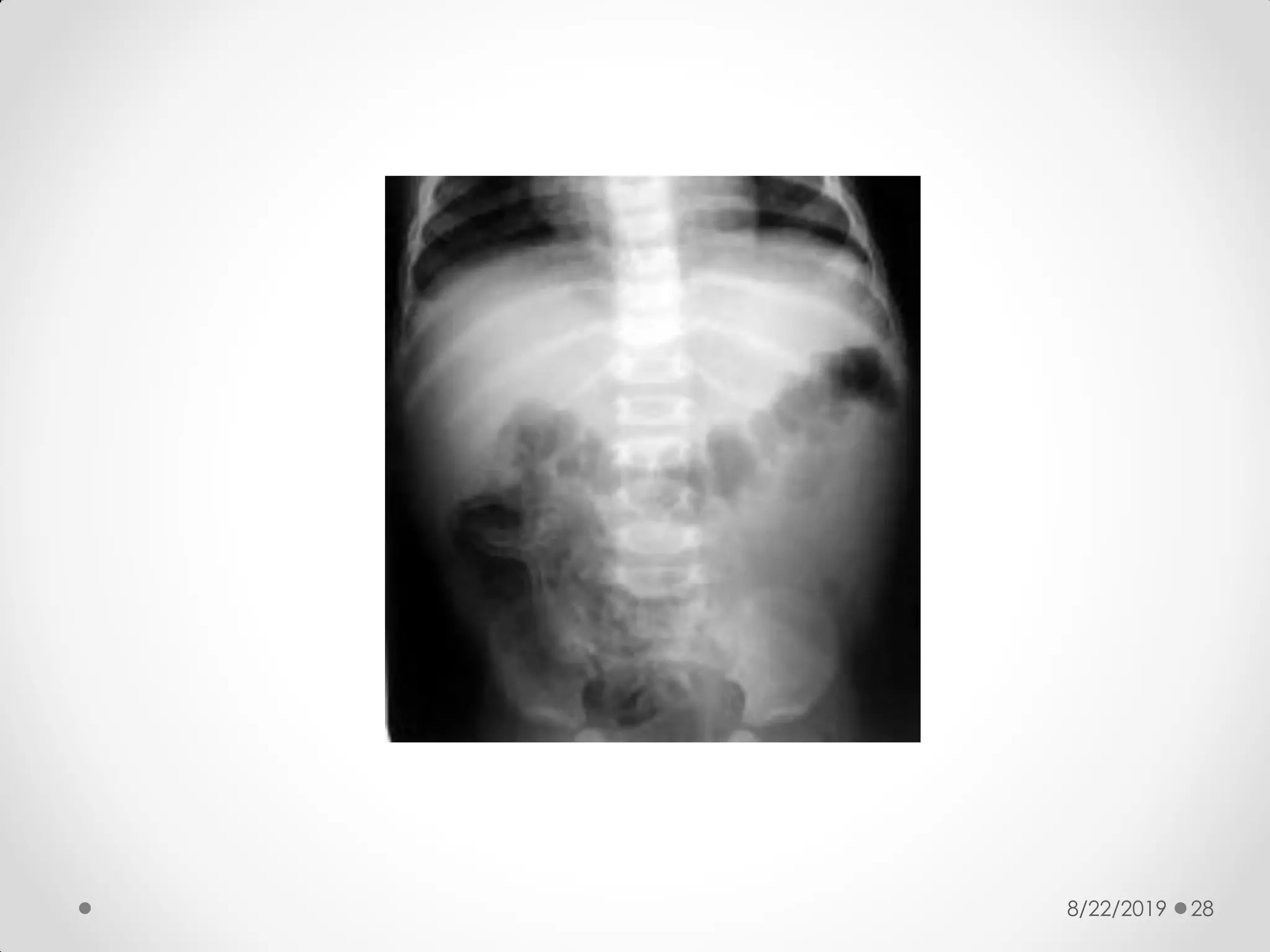 Necrotising Enterocolitis(NEC) | PDF