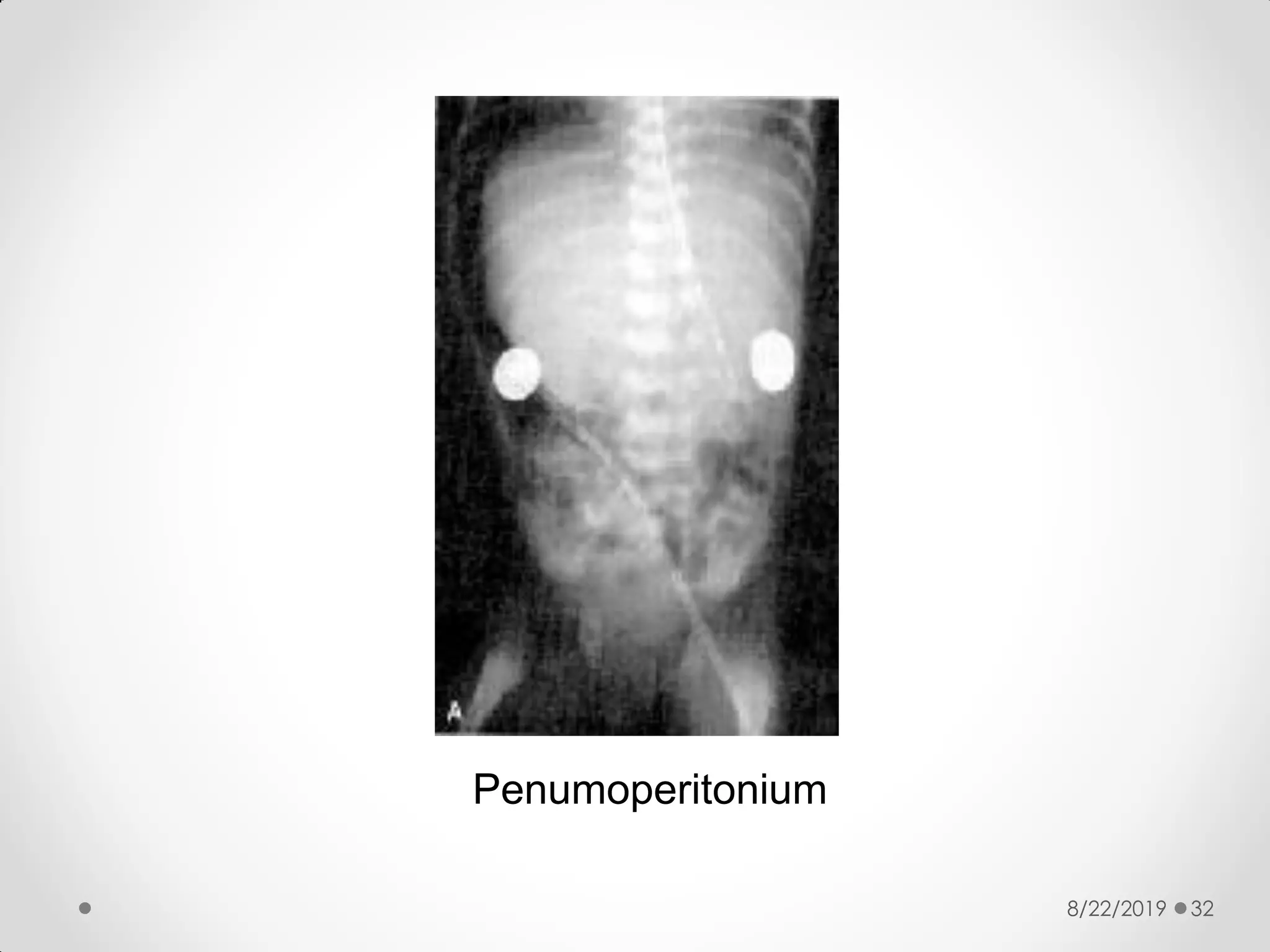 Necrotising Enterocolitis(NEC) | PDF | Parenting Babies and Toddlers ...