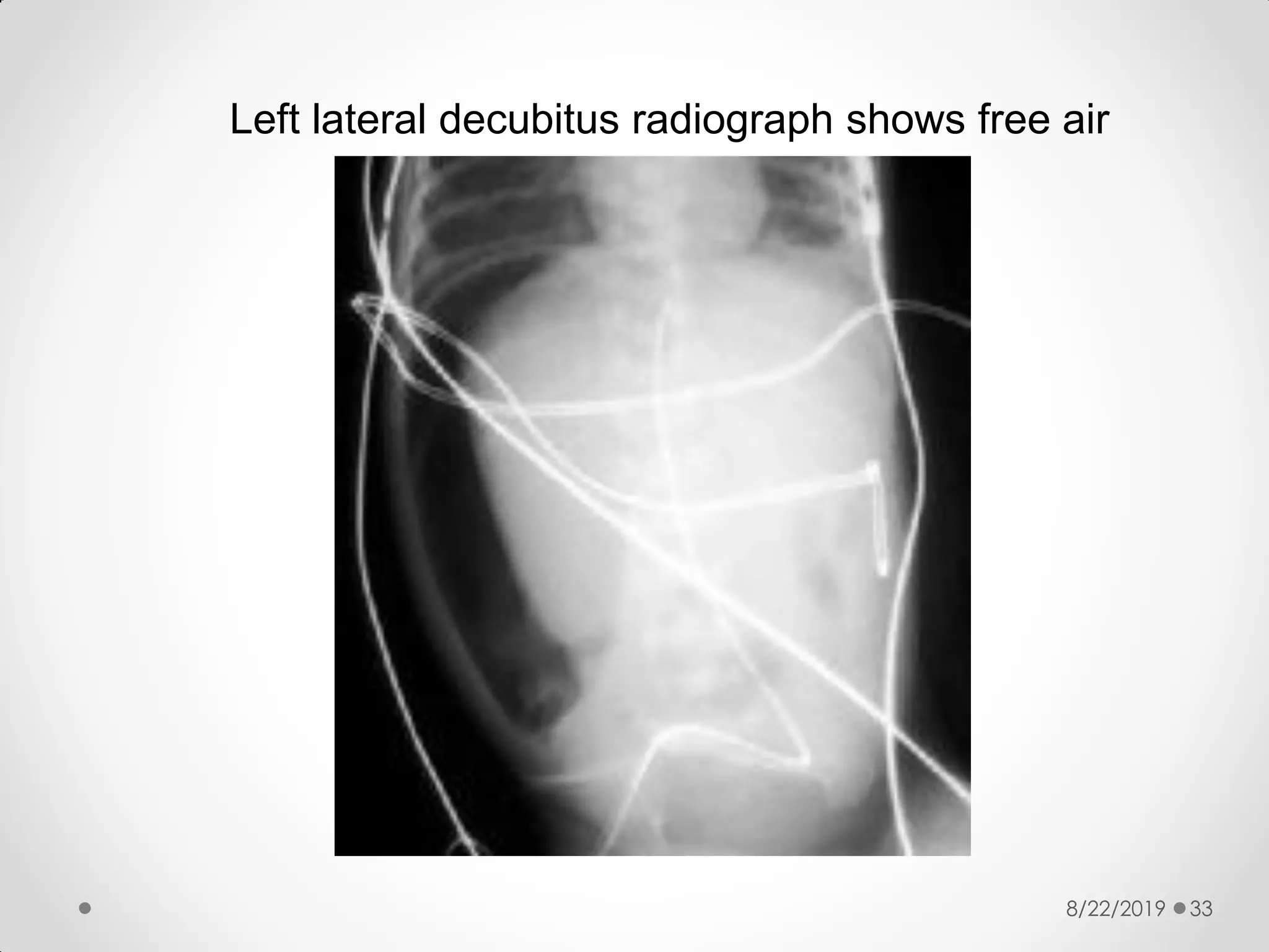 Necrotising Enterocolitis(NEC) | PDF | Parenting Babies and Toddlers ...