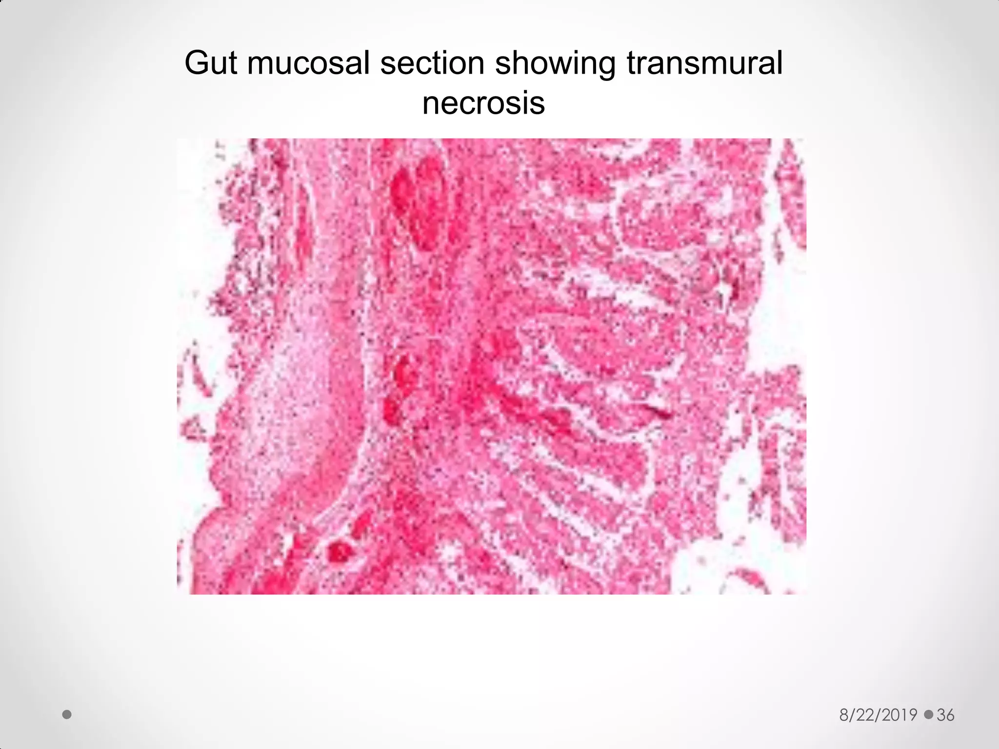 Necrotising Enterocolitis(NEC) | PDF
