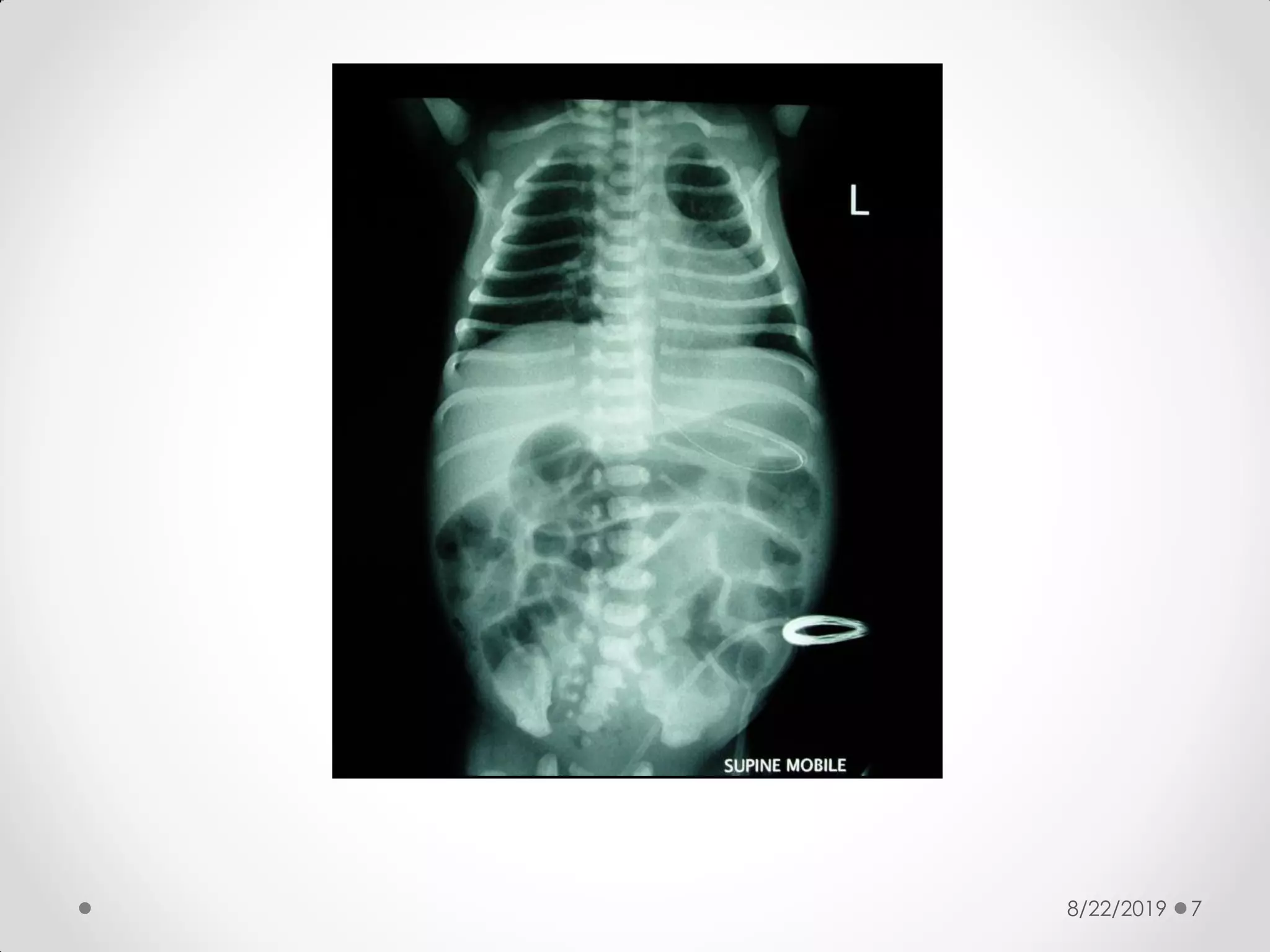 Necrotising Enterocolitis(NEC) | PDF