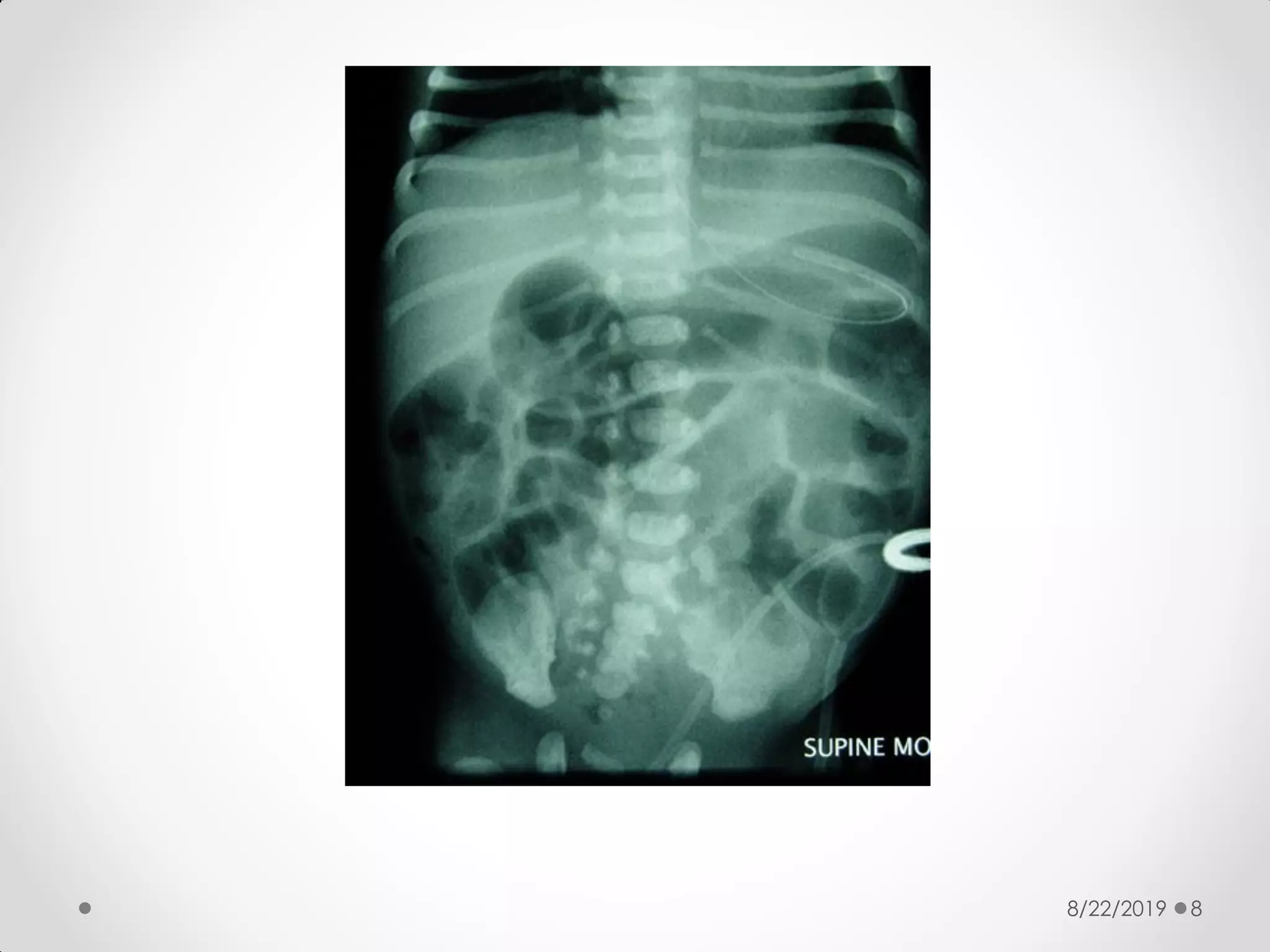 Necrotising Enterocolitis(NEC) | PDF