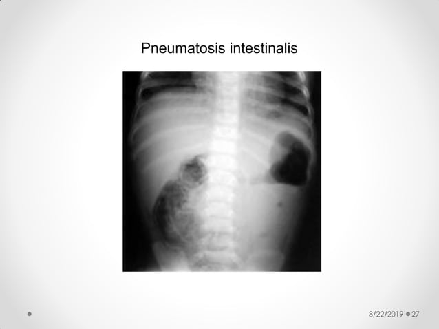 Necrotising Enterocolitis(NEC) | PDF | Parenting Babies and Toddlers ...