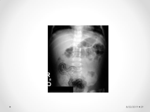 Necrotising Enterocolitis(NEC) | PDF | Parenting Babies and Toddlers ...