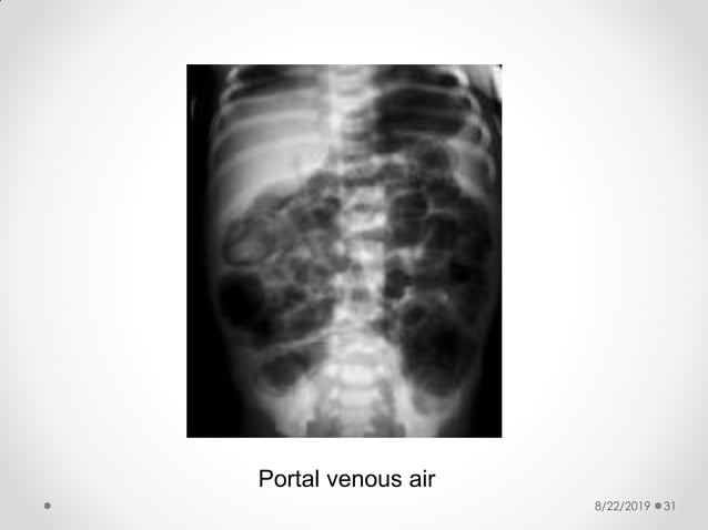 Necrotising Enterocolitis(NEC) | PDF | Parenting Babies and Toddlers ...