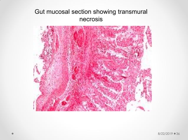 Necrotising Enterocolitis(NEC) | PDF | Parenting Babies and Toddlers ...