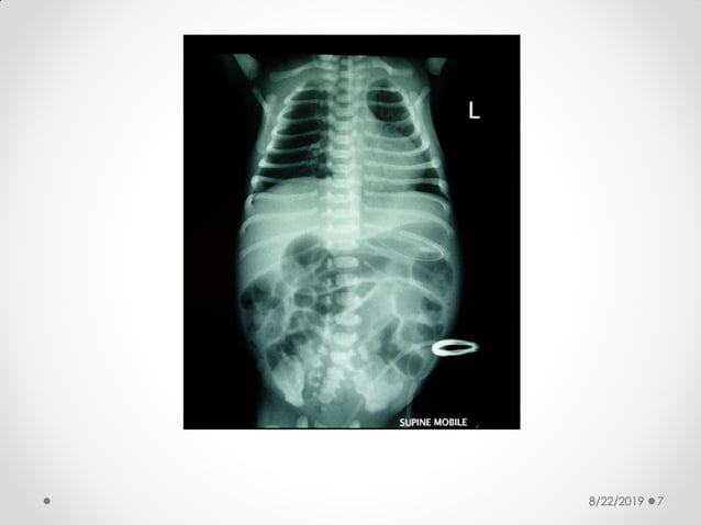 Necrotising Enterocolitis(NEC) | PDF | Parenting Babies and Toddlers ...