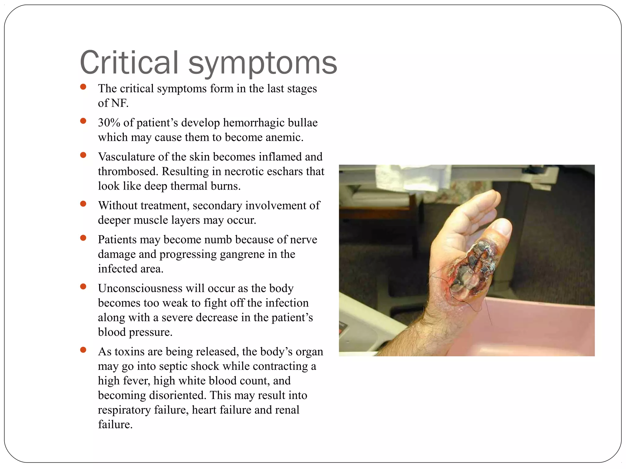 Necrotising fascitis | PPT