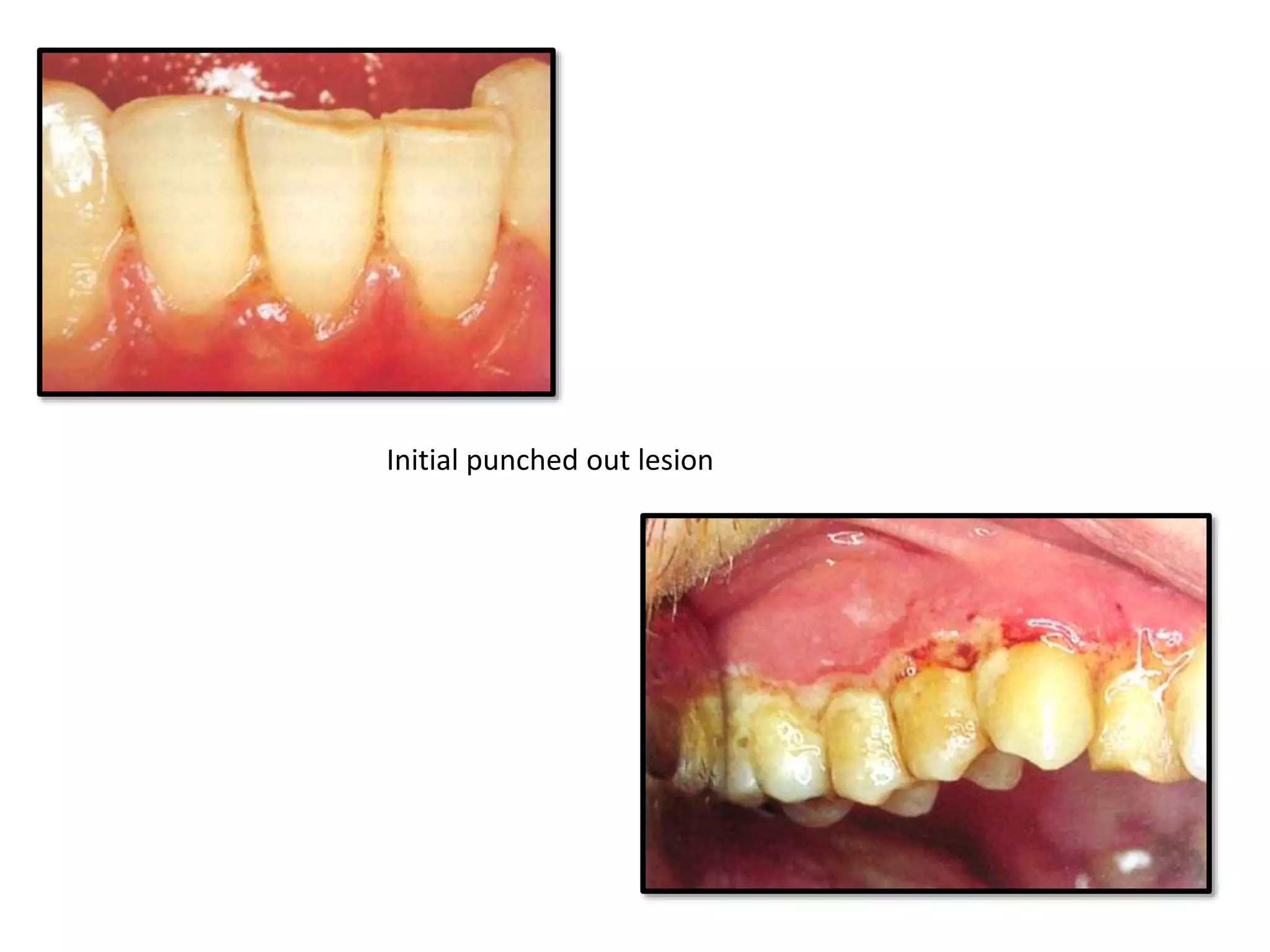 Necrotising periodontal diseases | PPTX
