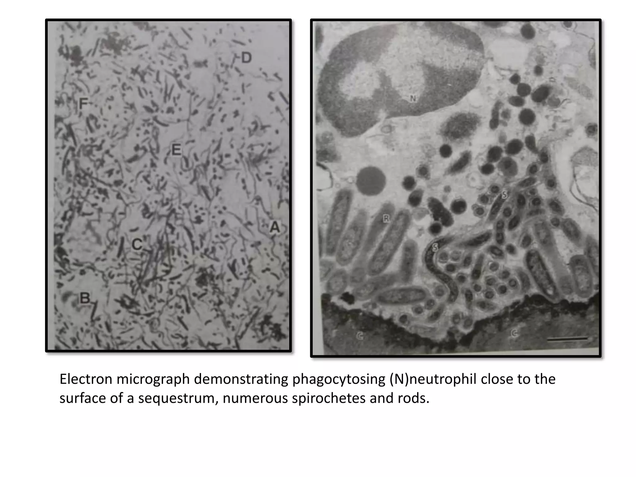 Necrotising periodontal diseases | PPTX