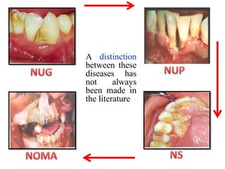 Necrotizing Ulcerative Gingivitis Vs Necrotizing Ulcerative Periodontitis