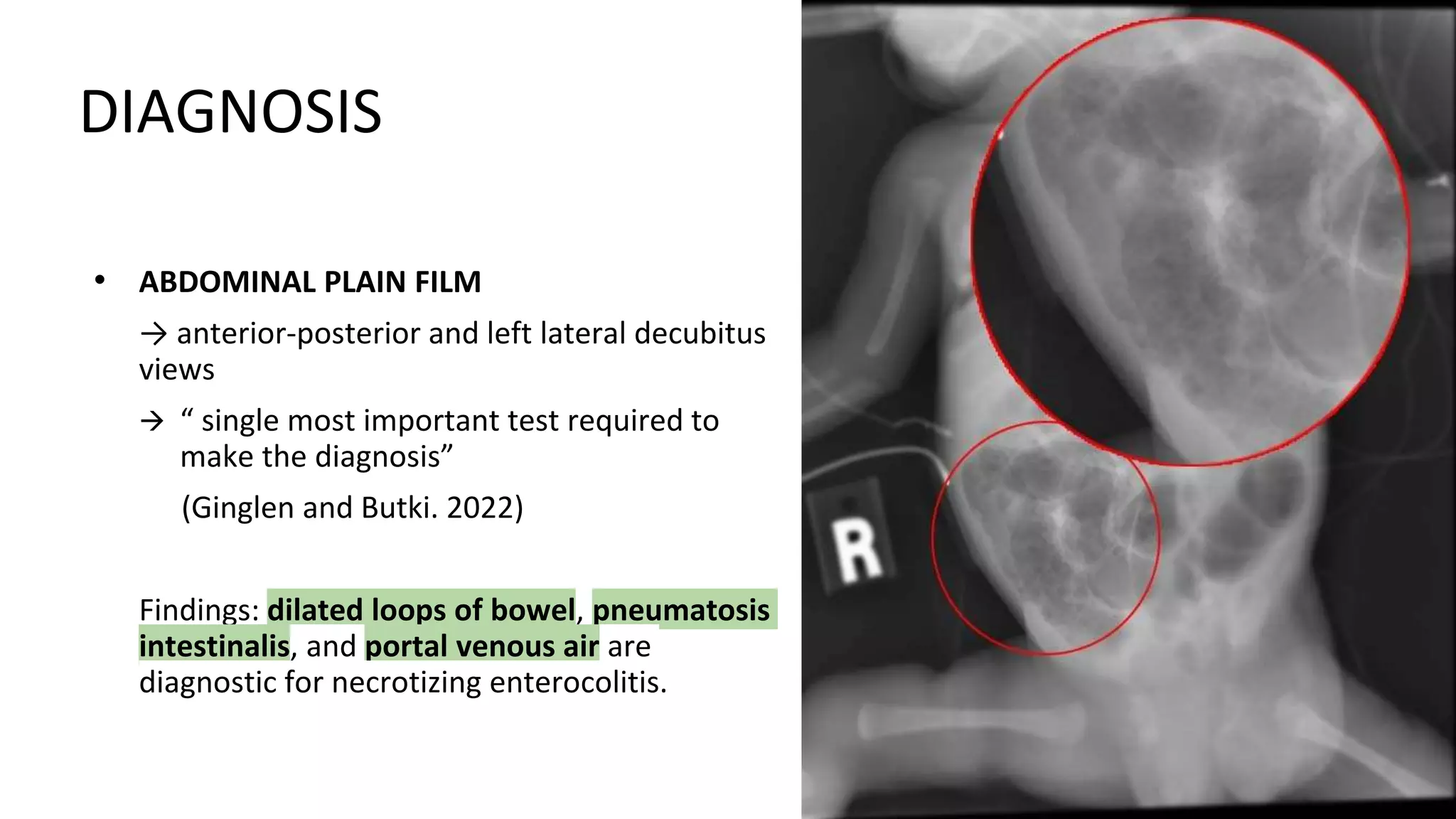 NECROTIZING-ENTEROCOLITIS-1.pptx