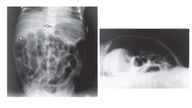 NECROTIZING-ENTEROCOLITIS-1.pptx