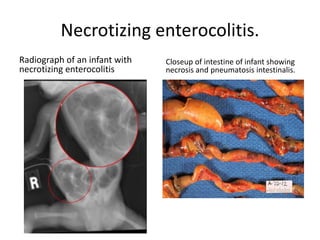 Necrotizing enterocolitis | PPT
