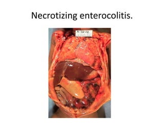 Necrotizing enterocolitis | PPT
