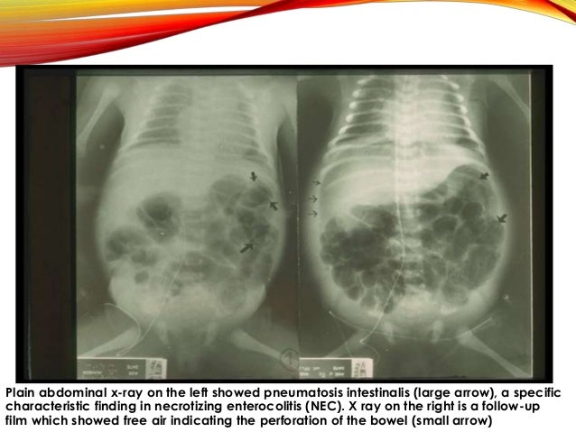 Necrotizing enterocolitis