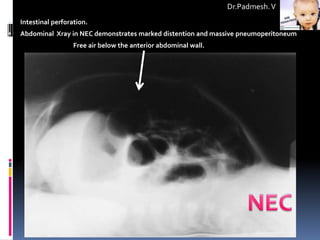 Necrotizing Entero Colitis.. Dr.Padmesh | PPTX