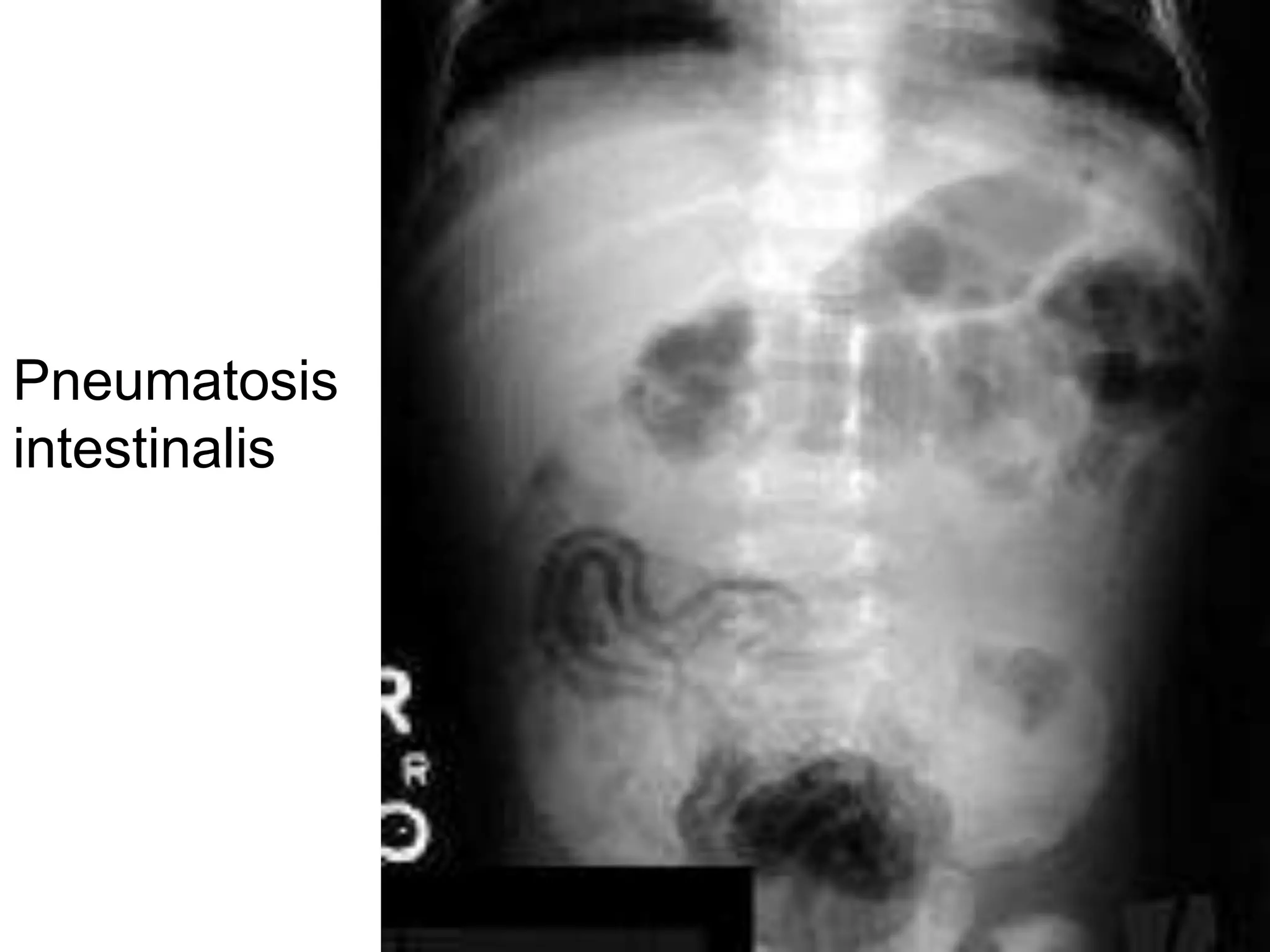 necrotizing enterocolitis 1shri.ppt