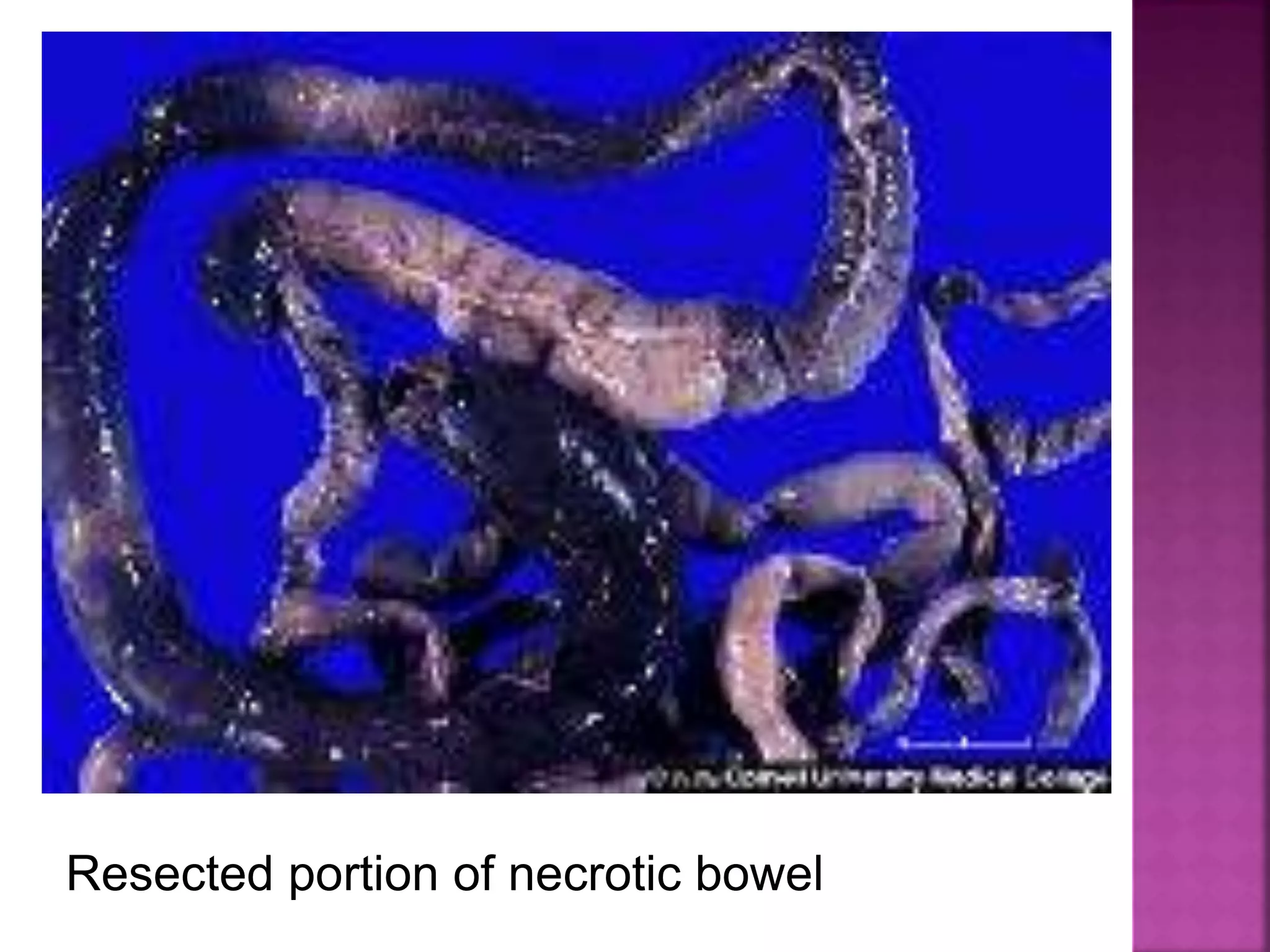 necrotizing enterocolitis 1shri.ppt