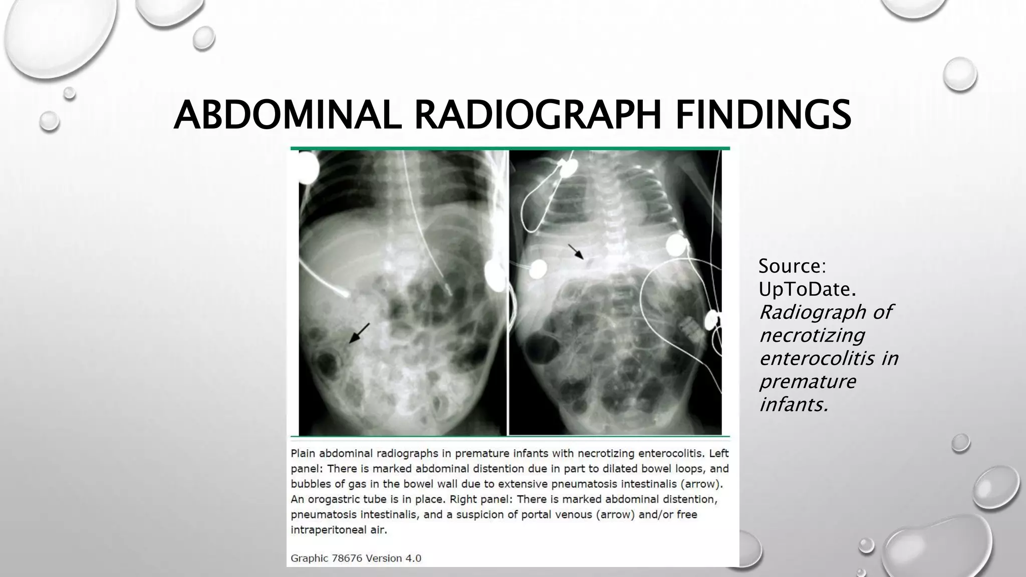 Necrotizing enterocolitis | PPTX | Digestive Disorders | Diseases and ...