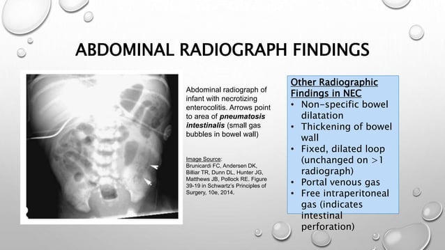 Necrotizing enterocolitis | PPT
