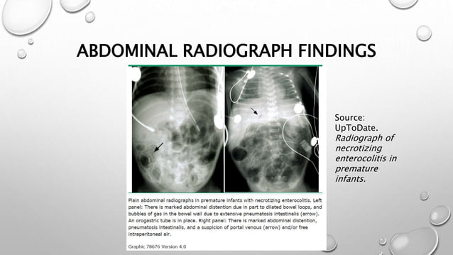 Necrotizing enterocolitis | PPT