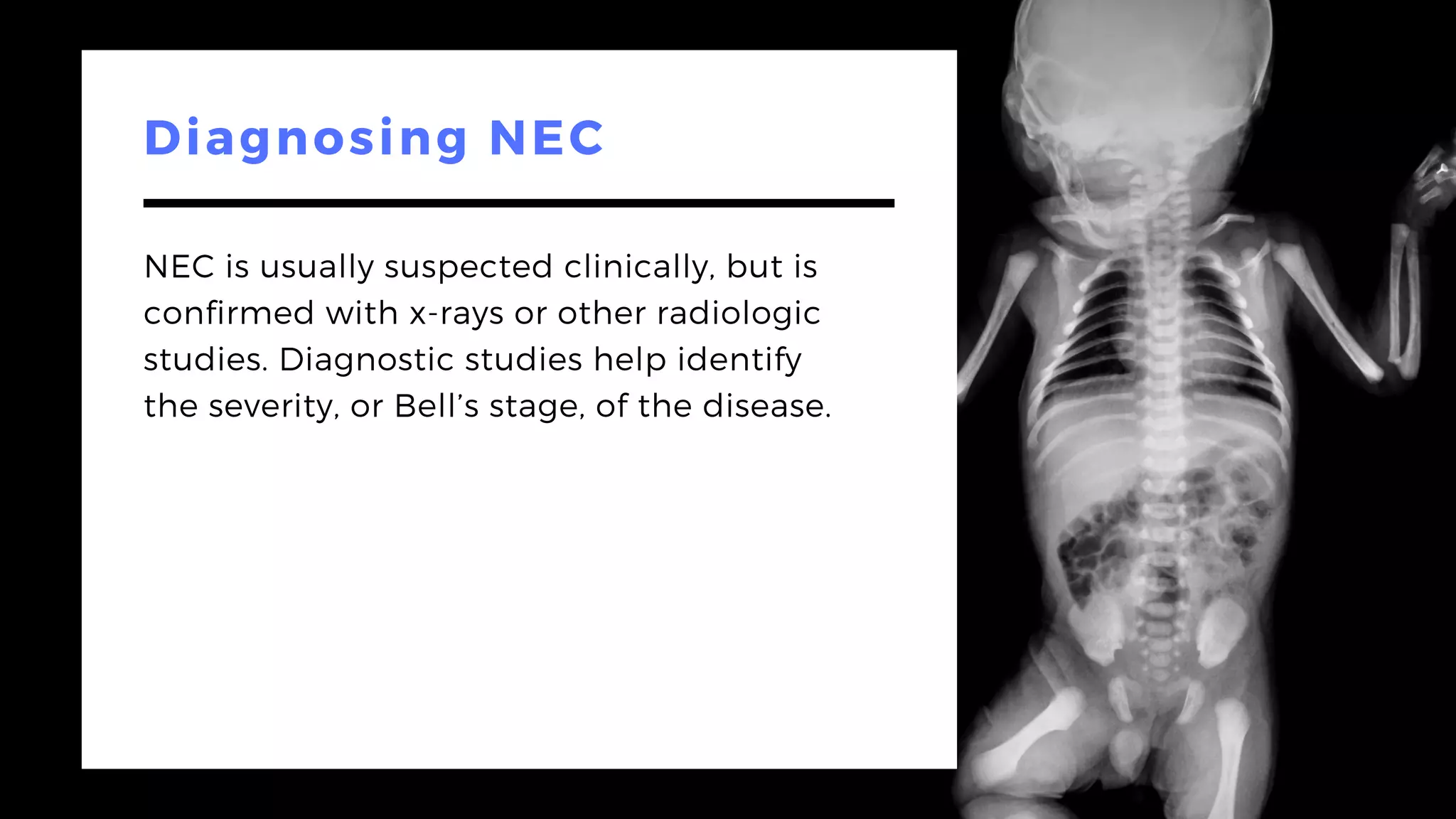 Necrotizing Enterocolitis (NEC) in Premature Babies | PDF