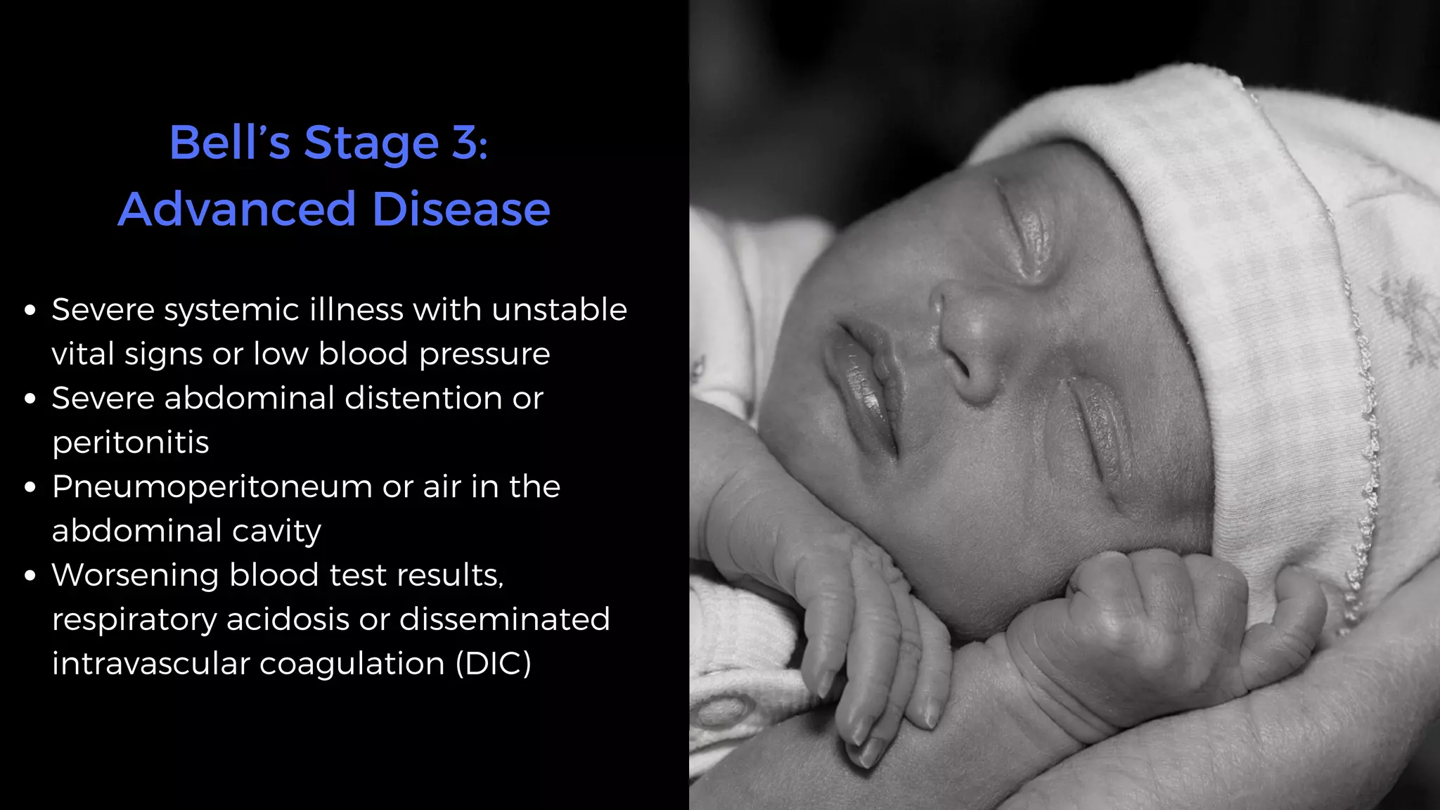 Necrotizing Enterocolitis (NEC) in Premature Babies | PDF