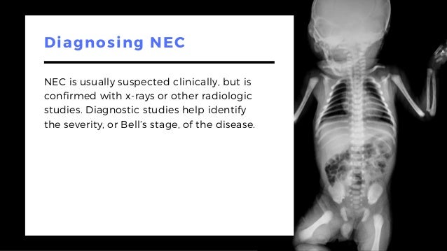 Necrotizing Enterocolitis (NEC) in Premature Babies