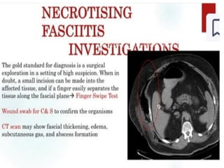Necrotizing facititis .pptx necrotising fasciitis | PPTX