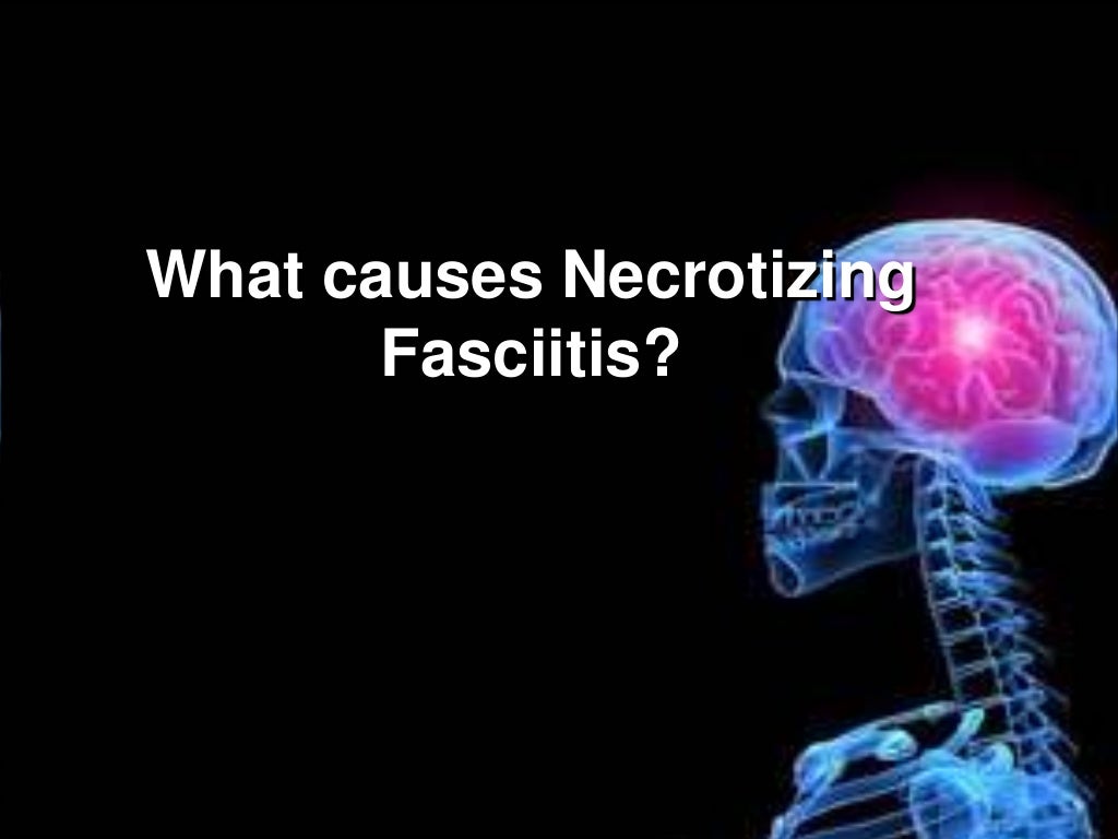 Necrotizing Fasciitis necrotizing-fasciitis
