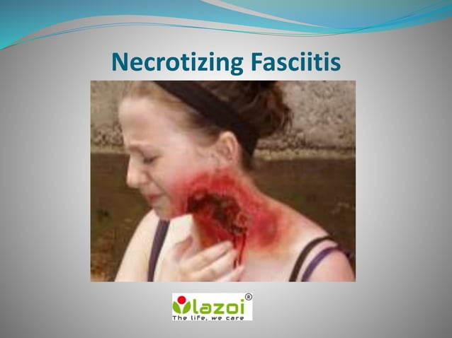Necrotizing fasciitis | PPT