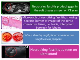 Necrotizing fasciitis | PPTX