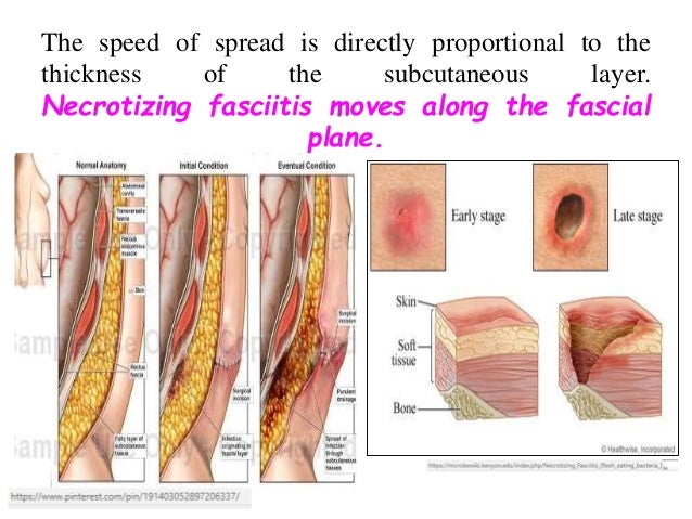 Necrotizing fasciitis