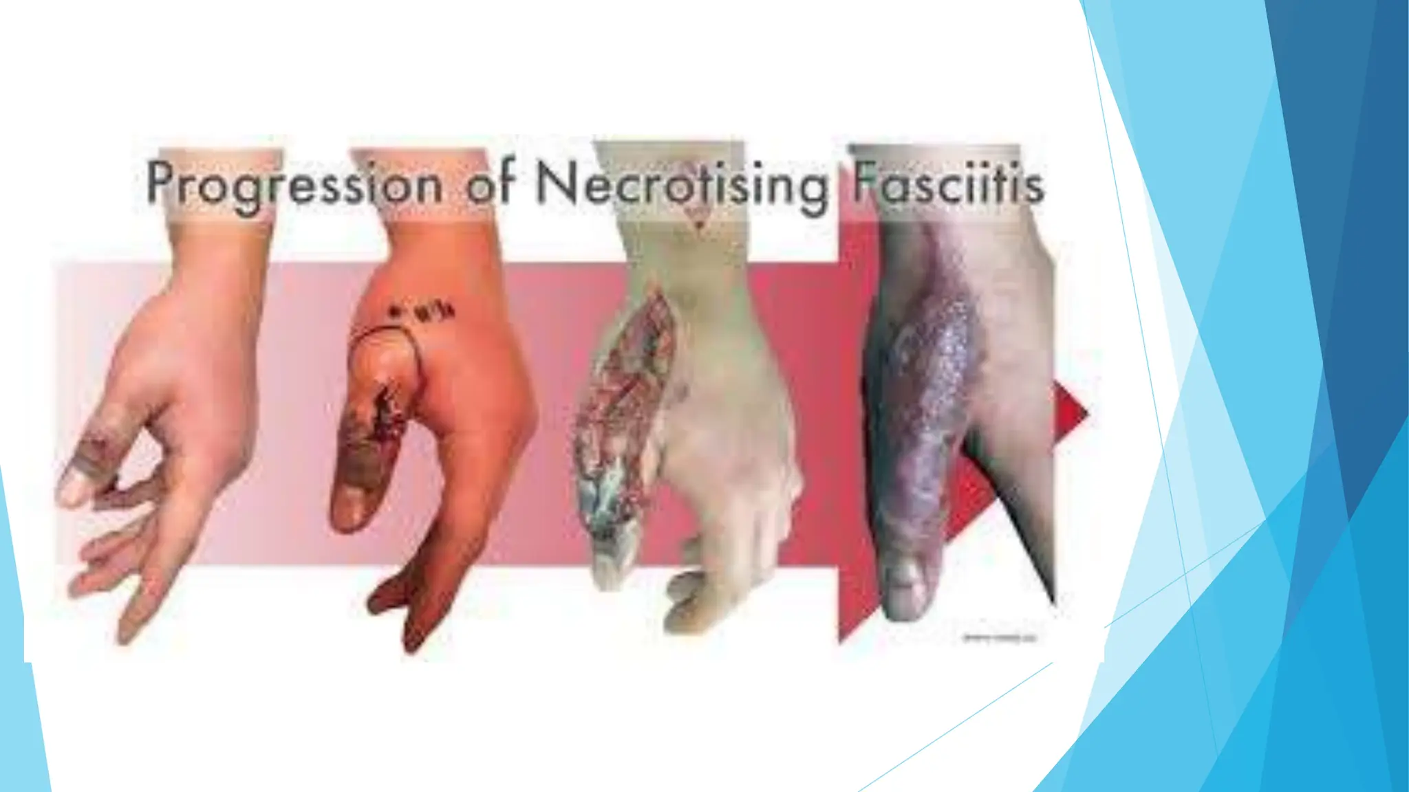 Necrotizing Fasciitis ppt by Dr Ahmed Zubair Abbasi.pptx