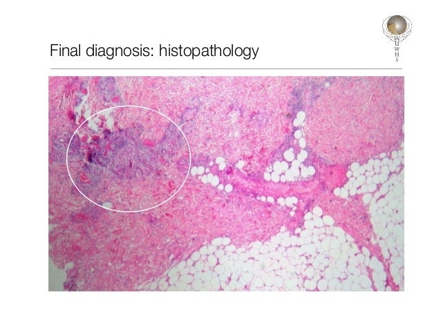 Mrsa Necrotizing Fasciitis