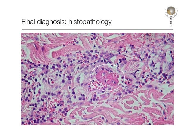 Necrotizing fasciitis