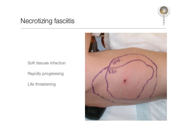 Necrotizing fasciitis