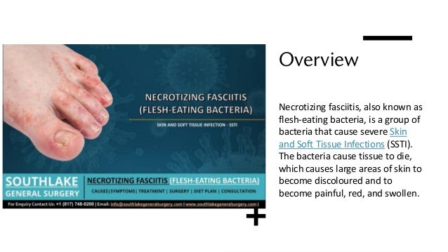 Necrotizing Fasciitis (Flesh-Eating Bacteria) – SSTI.pdf Necrotizing Fasciitis (Flesh-Eating Bacteria) – SSTI.pdf