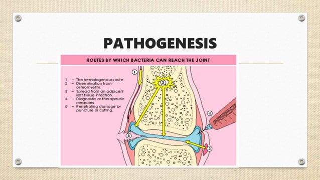 NECROTIZING FASCIITIS, GAS GANGRENE AND SEPTIC ARTHRITIS (1).pptx ...