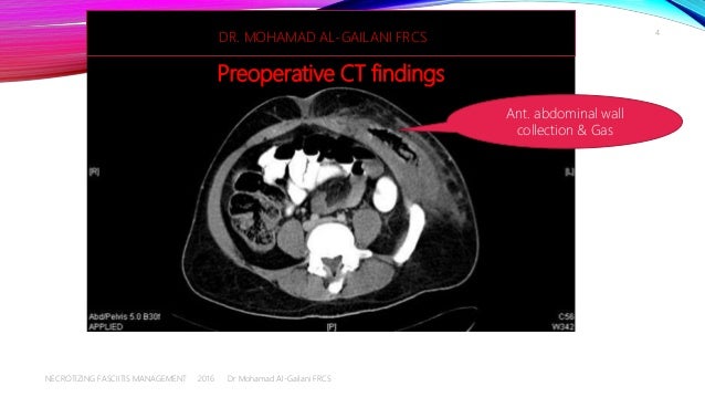 Necrotizing Fasciitis management
