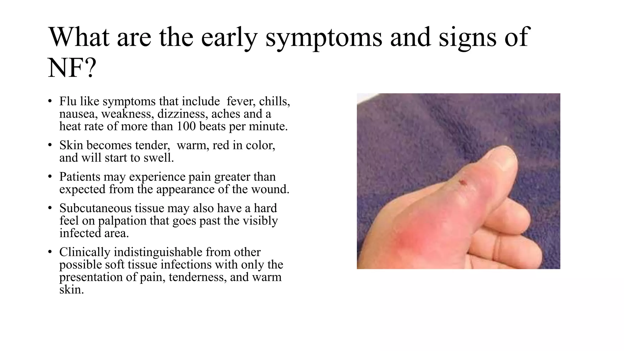 Necrotizing fascitis | PPTX