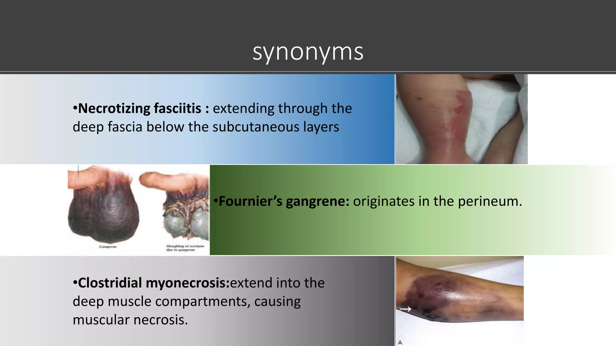 Necrotizing fascitis | PPTX