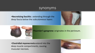 Necrotizing fascitis | PPTX