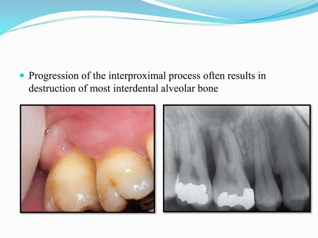 Necrotizing periodontal diseases by Dr Rinky Tripathi pg 2nd year ...