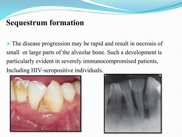 Necrotizing periodontal diseases by Dr Rinky Tripathi pg 2nd year ...