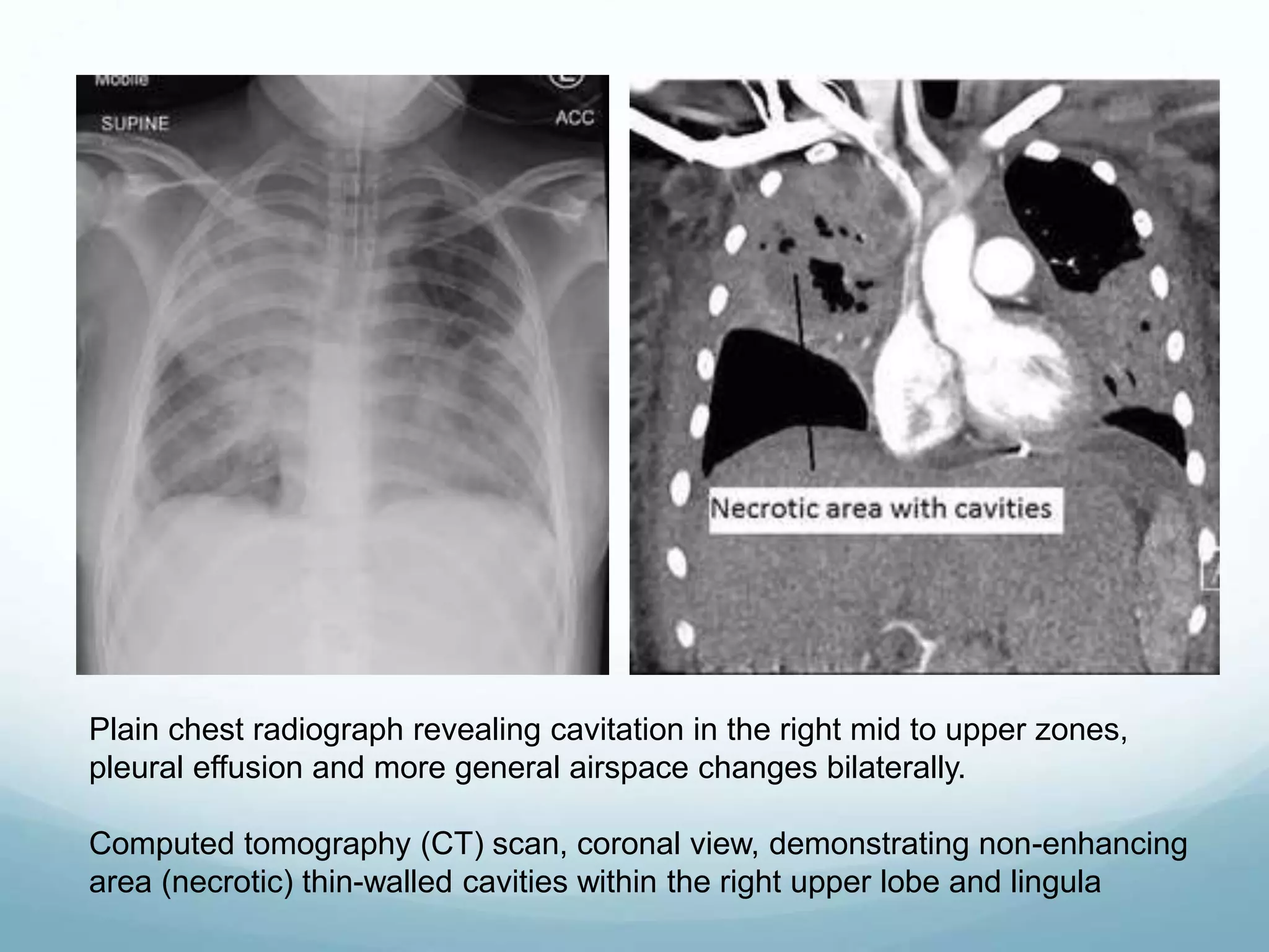 necrotizing pneumonia.ppt