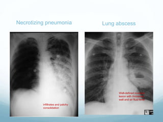 necrotizing pneumonia.ppt